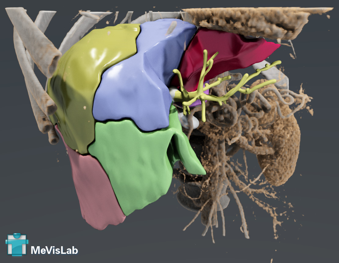 Example 6: MeVis Path Tracer